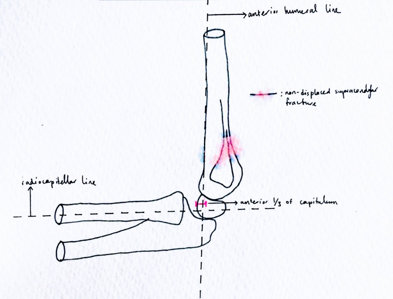 The Pediatric Elbow; Looking for Clues – mskemergencies.com